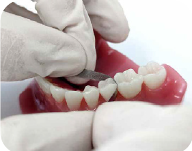 Performing IPR – KlearFX Clear Aligner Treatment Planning and Manufacturing