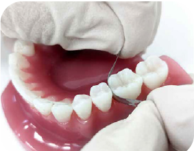 Performing IPR – KlearFX Clear Aligner Treatment Planning and Manufacturing